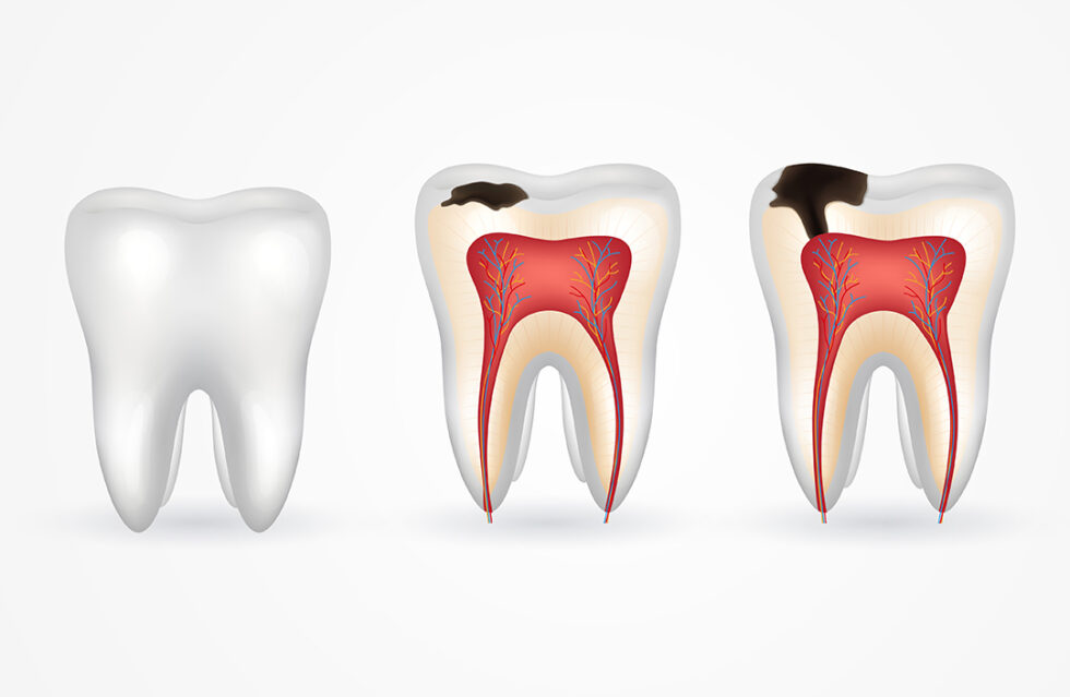 Carii dentare - Cabinet Stomatologic DentPlus