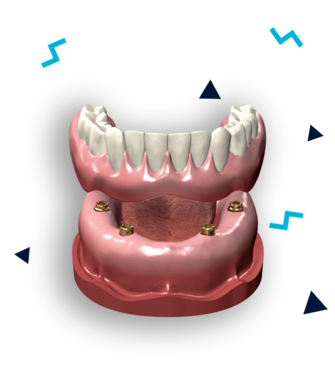 Proteza fixa pe implanturi - Cabinet Stomatologic DentPlus